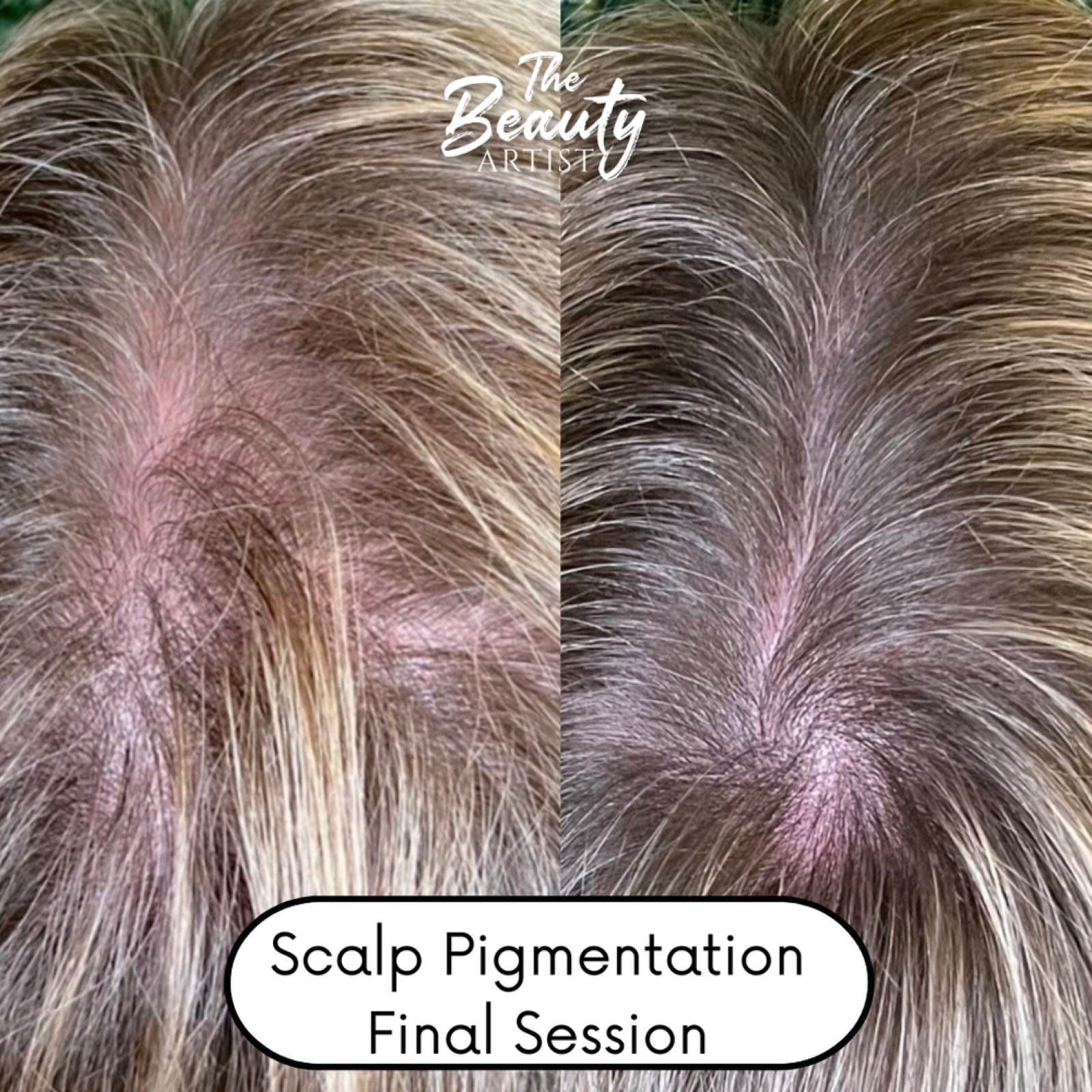 Scalp Pigmentation - The Beauty Artist